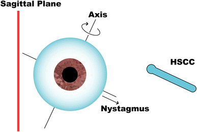 Cupulolithiasis of the horizontal semicircular canal | SpringerLink