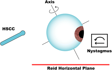 Cupulolithiasis of the horizontal semicircular canal | SpringerLink