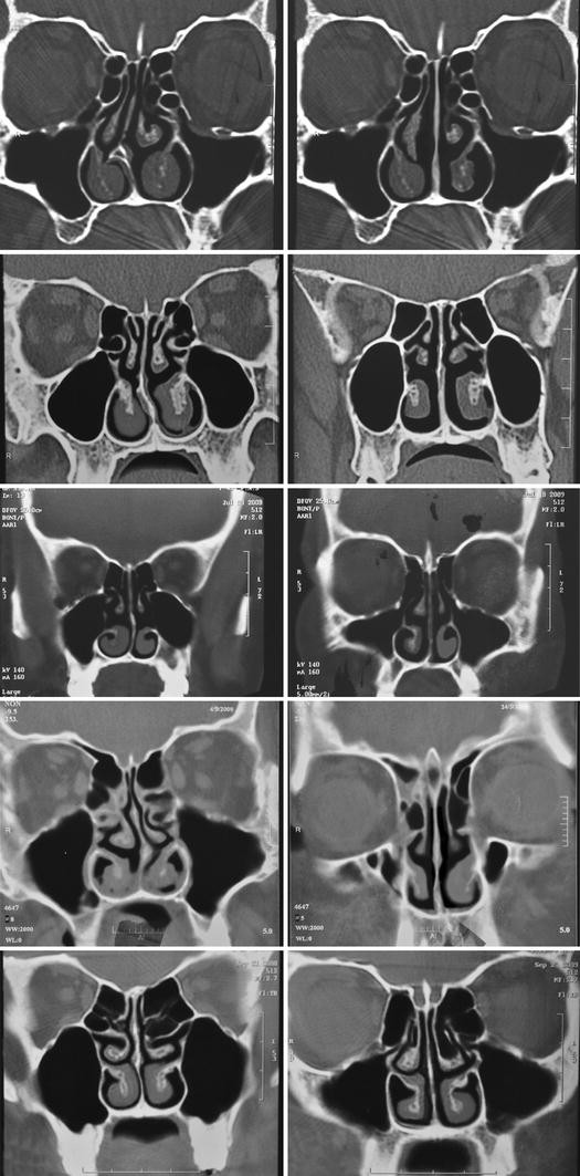 Nasal soft tissue obstruction improvement after septoplasty without ...
