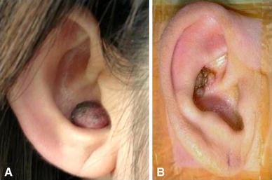 Clinical and histological characteristics of melanocytic nevus in ...