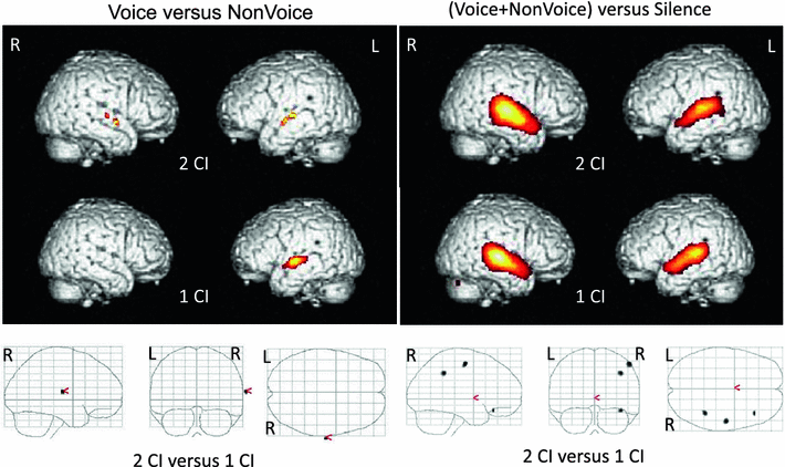 Brain voice processing with bilateral cochlear implants: a positron ...