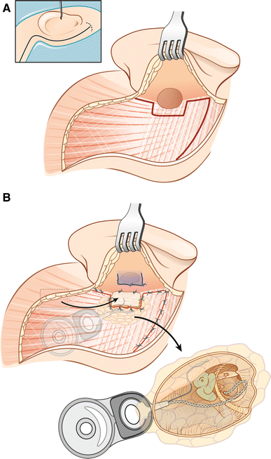 The use of subtotal petrosectomy in cochlear implant candidates with ...