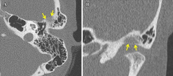 Osteoid osteoma of the temporal bone manifesting as first bite syndrome ...