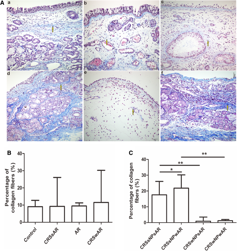 Different effects of allergic rhinitis on nasal mucosa remodeling in ...