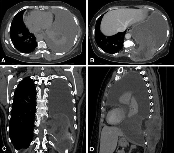 Lung and Chest-Wall Metastasis of Liposarcoma | SpringerLink