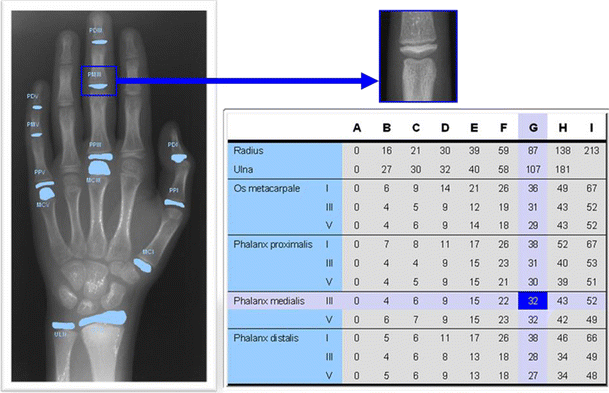 Skeletal age determination of the hand: a comparison of methods ...