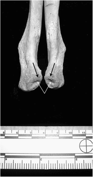 The lateral clavicular epiphysis: fusion timing and age estimation ...