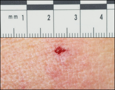 A patterned abrasion caused by the impact of a cartridge case may ...