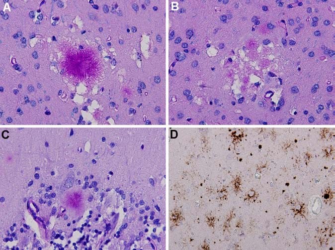 The first case of variant Creutzfeldt-Jakob disease in the Netherlands ...