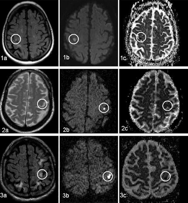 Ischemic stroke of the cortical “hand knob” area: stroke mechanisms and ...