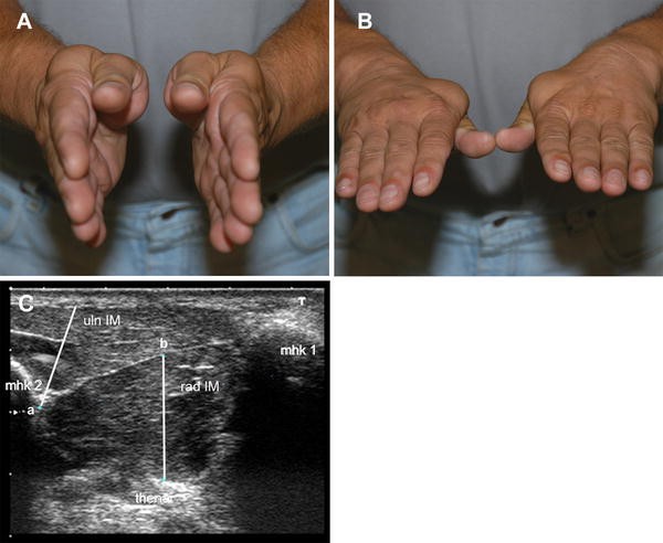 Myopathic changes in bilateral hypertrophy of the first dorsal ...