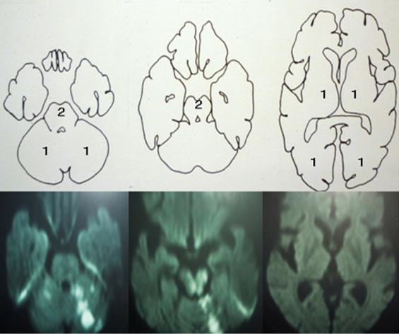 Posterior circulation ASPECTS on diffusion-weighted MRI can be a ...
