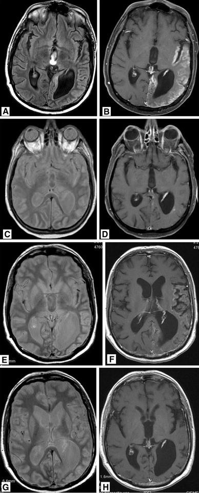 SMART syndrome: a late reversible complication after radiation therapy ...