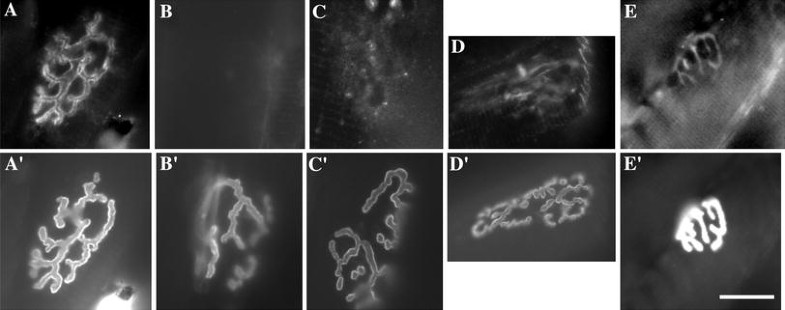 Anti-LRP4 autoantibodies in AChR- and MuSK-antibody-negative myasthenia ...