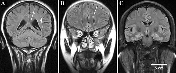White matter lesions in chronic migraine with medication overuse ...