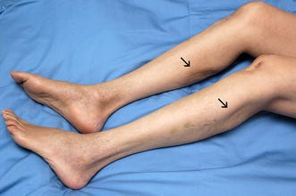 Dissociated lower limb muscle involvement in amyotrophic lateral ...