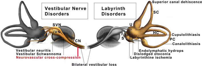 Vestibular paroxysmia: a treatable neurovascular cross-compression ...