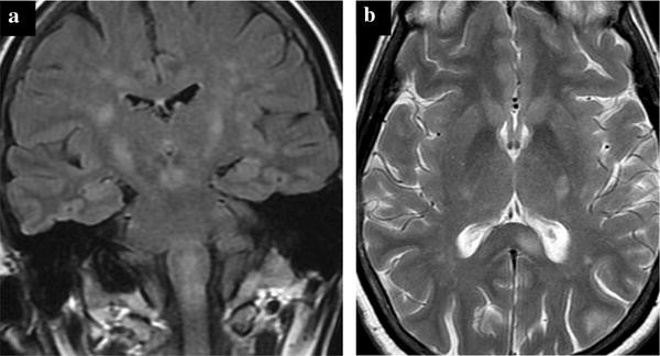 Human T-cell lymphotropic virus (HTLV)-associated encephalopathy: an ...