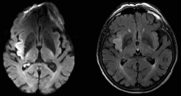 Letter to the editor: insular stroke presenting with acute onset of ...