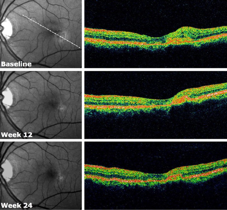 Intravitreal bevacizumab (Avastin) associated with the regression of ...