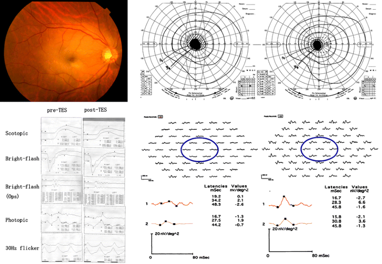 Transcorneal electrical stimulation of retina to treat longstanding ...