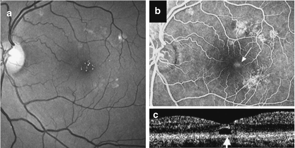 Macular cysts, holes and cavitations | SpringerLink