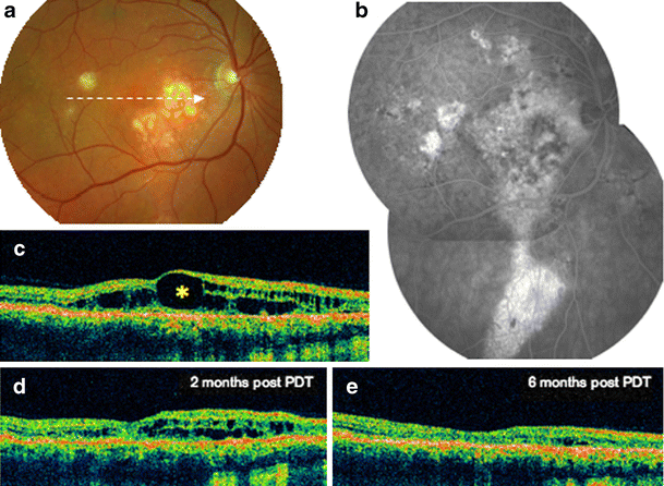 Macular cysts, holes and cavitations | SpringerLink