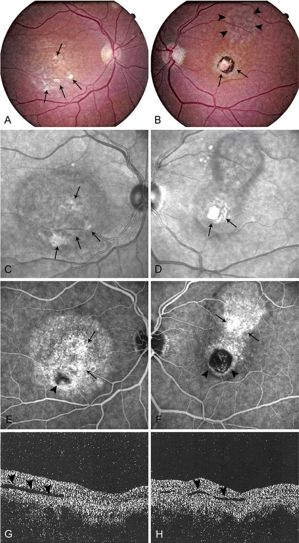 Clinicopathologic findings in Best vitelliform macular dystrophy ...