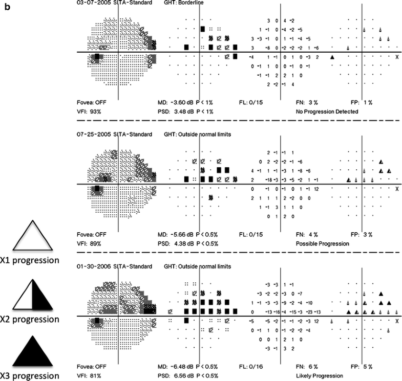 Detection of visual field progression in glaucoma with standard ...