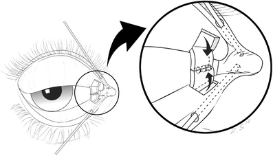 Treatment of refractory exposure keratitis with modified medial ...