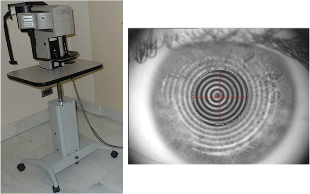 Measurement of angle Kappa with Orbscan II and Galilei G4: effect of ...