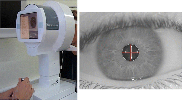 Measurement of angle Kappa with Orbscan II and Galilei G4: effect of ...
