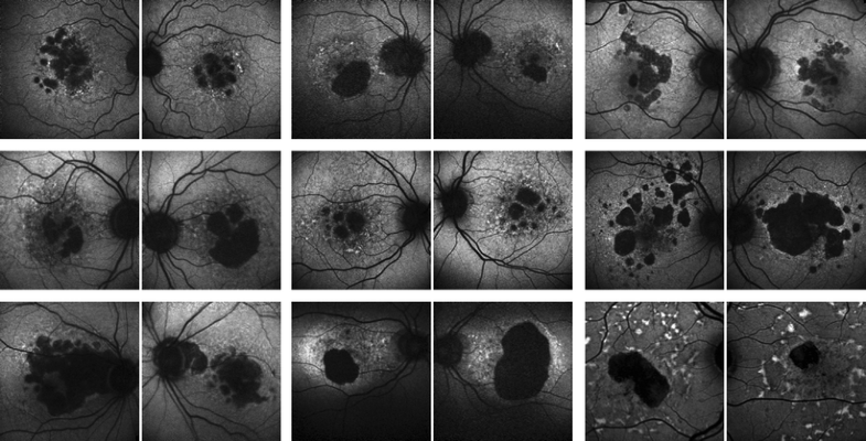 Fundus autofluorescence imaging in dry AMD: 2014 Jules Gonin lecture of ...