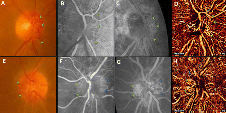 Morphological differences between optic disc collaterals and ...