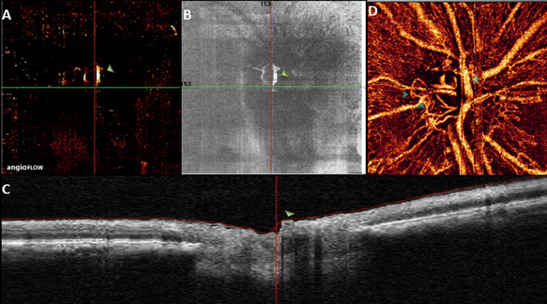 Morphological differences between optic disc collaterals and ...