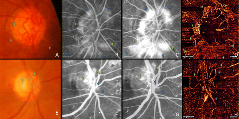 Morphological differences between optic disc collaterals and neovascularization on optical ...