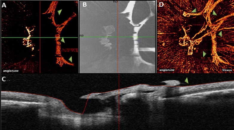 Morphological differences between optic disc collaterals and ...