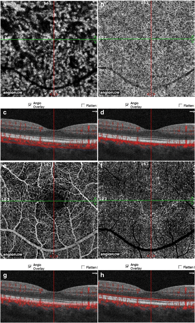 Characteristics of type 1 and 2 CNV in exudative AMD in OCT-Angiography ...