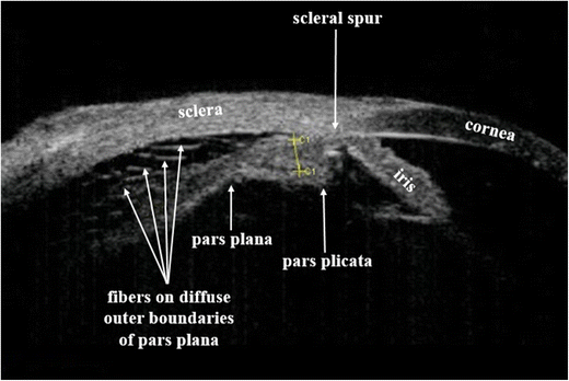 Ciliary body thickness changes after preoperative anti-inflammatory ...