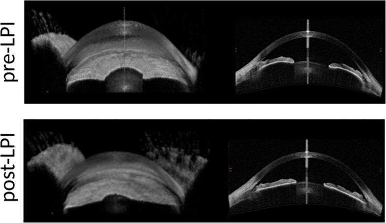 Low iris and anterior chamber volume is associated with deepening after ...