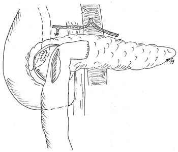 Prospective randomised comparison of organ-preserving pancreatic head ...