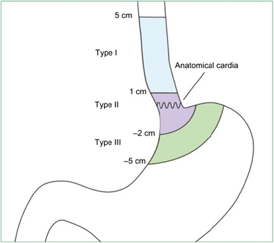 Surgical approaches to adenocarcinoma of the gastroesophageal junction ...