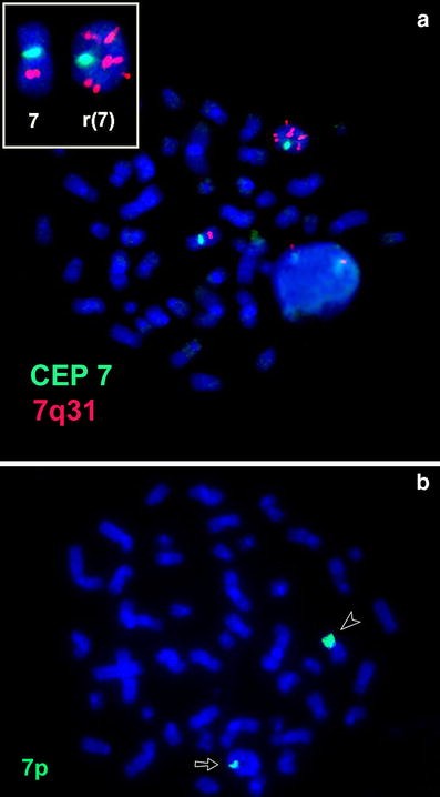 Hepatosplenic γδ T-cell lymphoma with ring chromosome 7, an ...