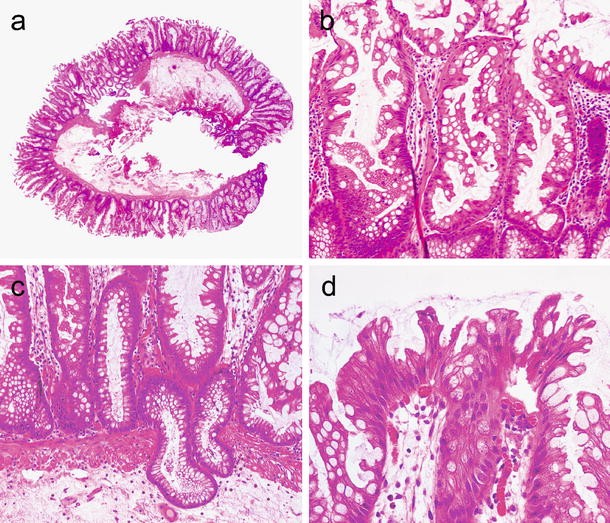 Serrated polyps of the colorectum: is sessile serrated adenoma ...