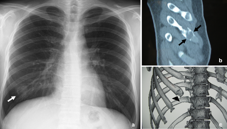 Perivascular epithelioid cell tumor of the rib | SpringerLink