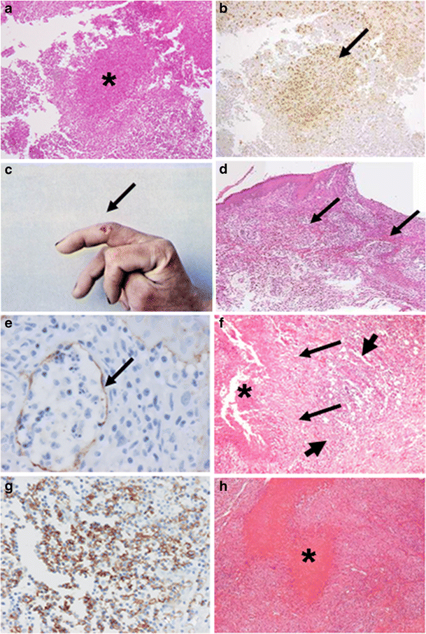 Temporal differences of onset between primary skin lesions and regional ...