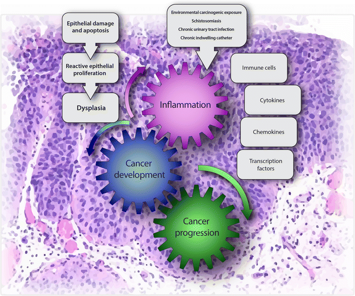 Chronic inflammation in urothelial bladder cancer | SpringerLink