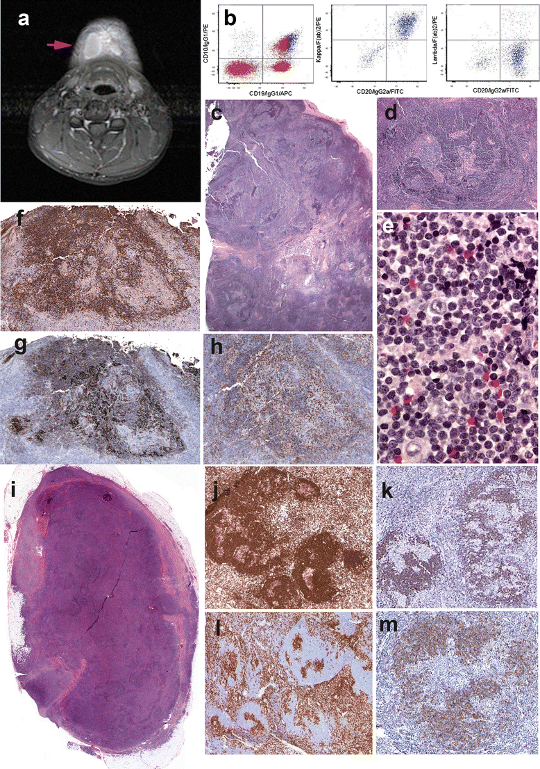 Indolent lymphomas in the pediatric population: follicular lymphoma ...
