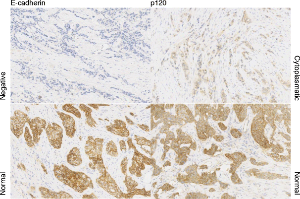 Correlation between E-cadherin and p120 expression in invasive ductal ...