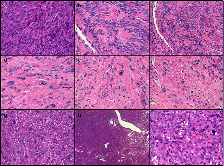 Fumarate hydratase (FH) deficiency in uterine leiomyomas: recognition ...